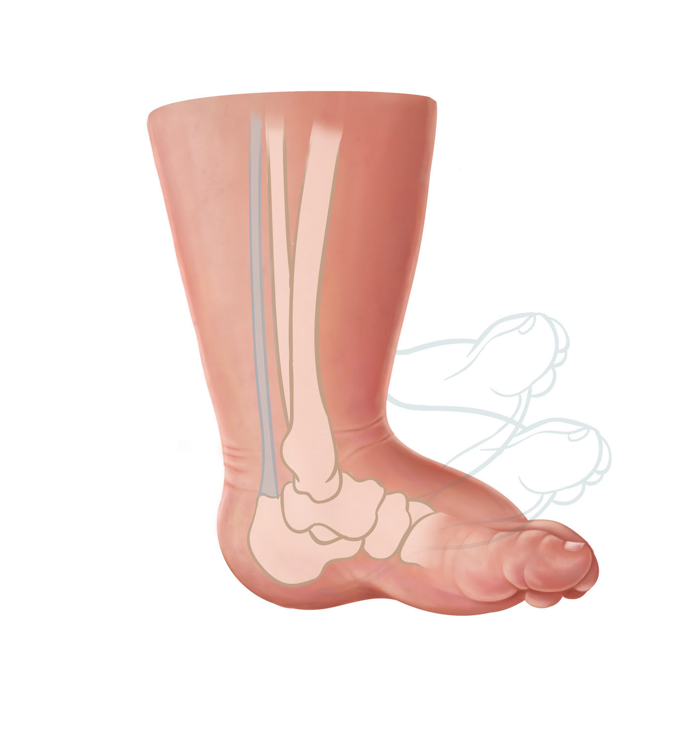 Emma Scheltema Illustration - Clubfoot Tenotomy for Starship Child Health