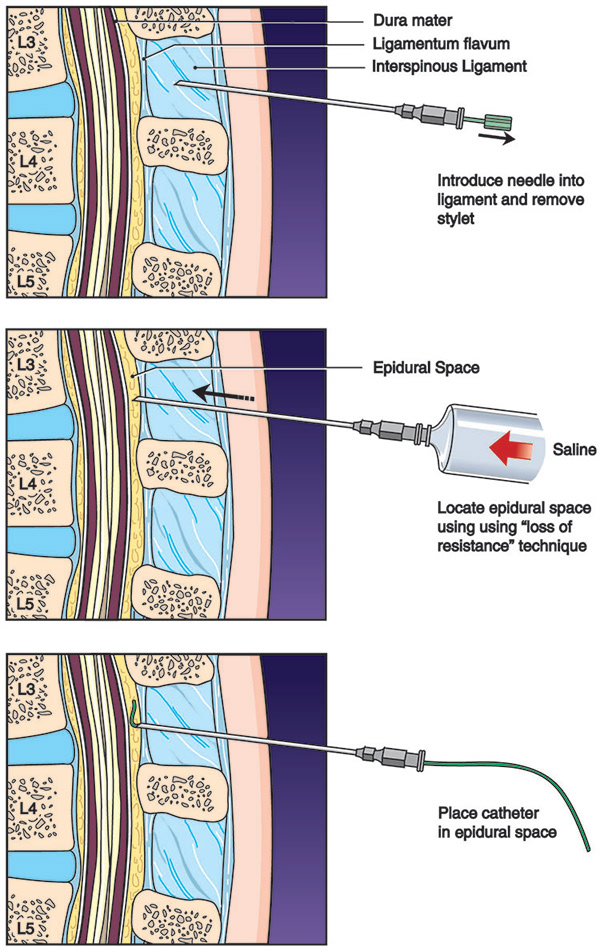 Christine Kaminski - Epidural