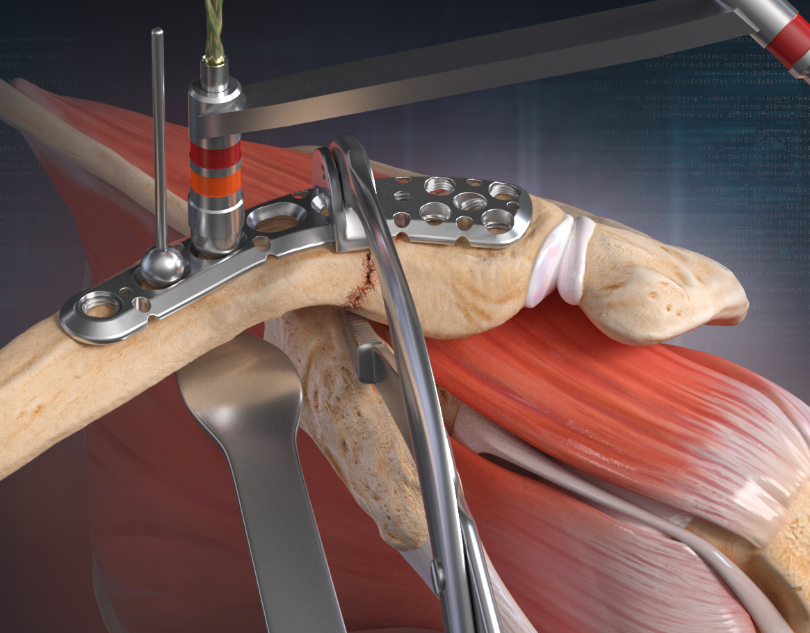 Eckhold Biomedical Illustration - CLAVICLE FRACTURE REPAIR WITH ...